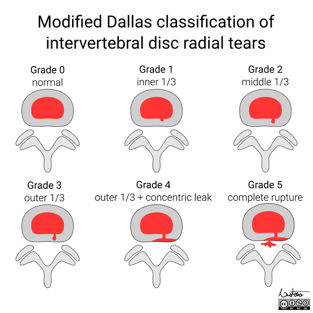 Annular Tear: 7 Breakthrough Treatments for Lasting Relief