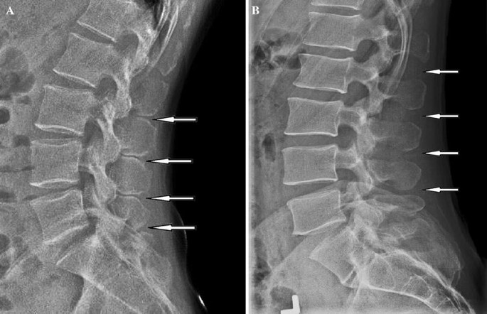 Baastrup’s Syndrome: 5 Critical Facts You Must Know - SpinePain Solutions