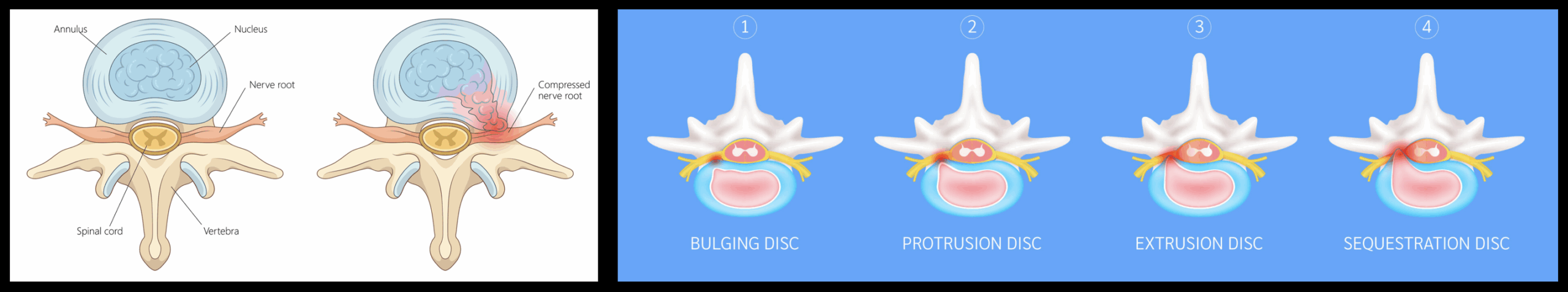 Disc Bulge: 7 Valuable Insights for Fast, Lasting Relief