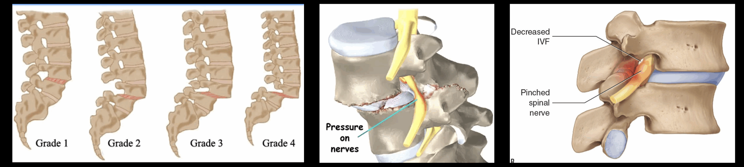Isthmic Spondylolisthesis: 5 Powerful Insights for Patients