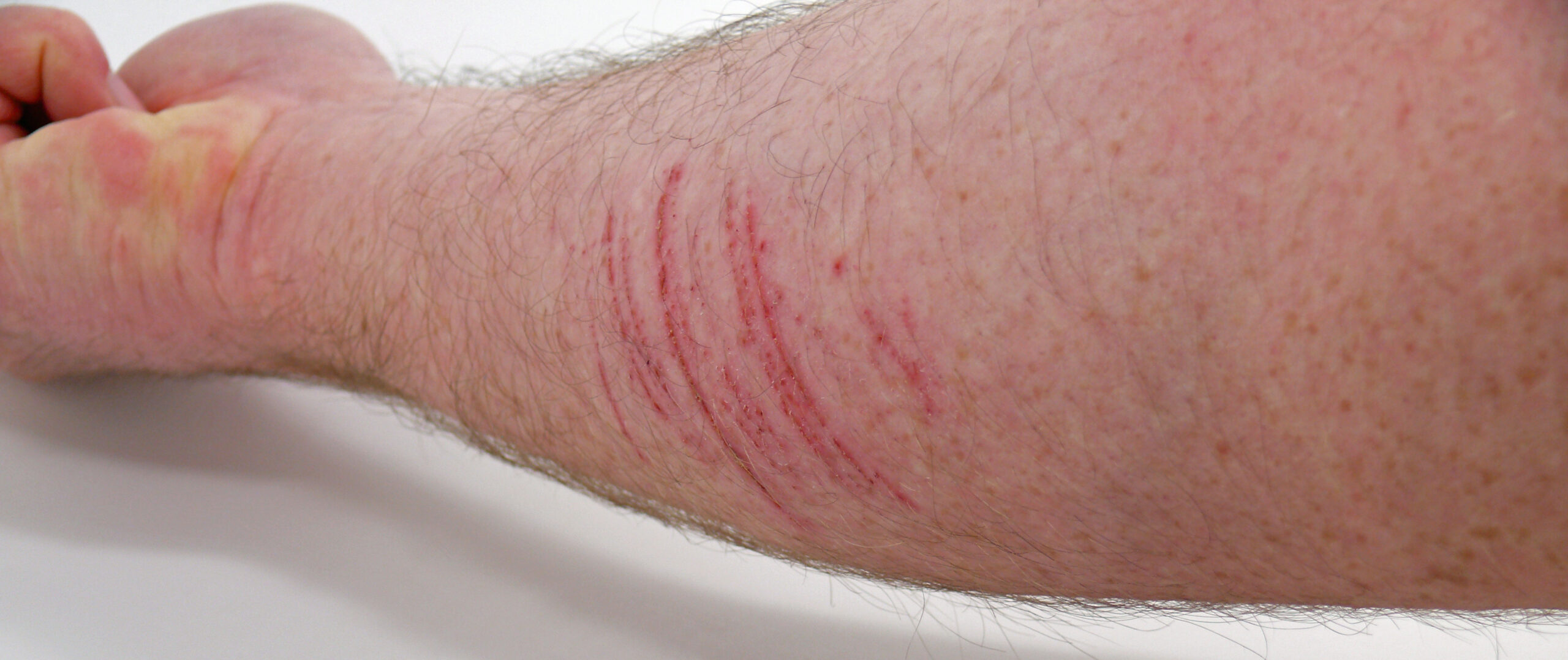 Forearm Pain: 7 Essential Facts for Relief and Recovery