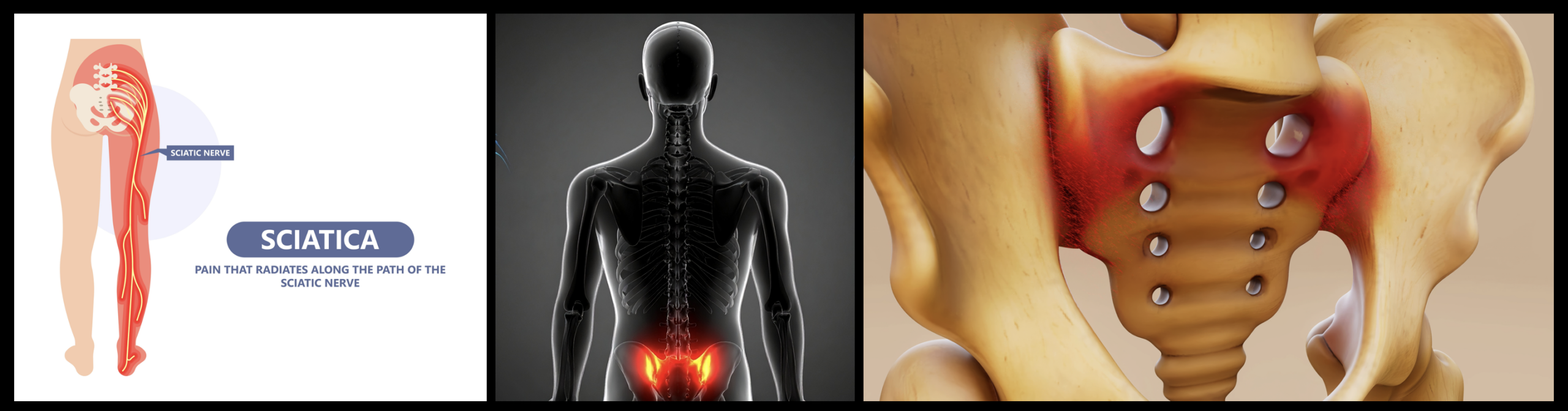 Sciatica vs SI Joint Pain: 3 Essential Clarity Tips